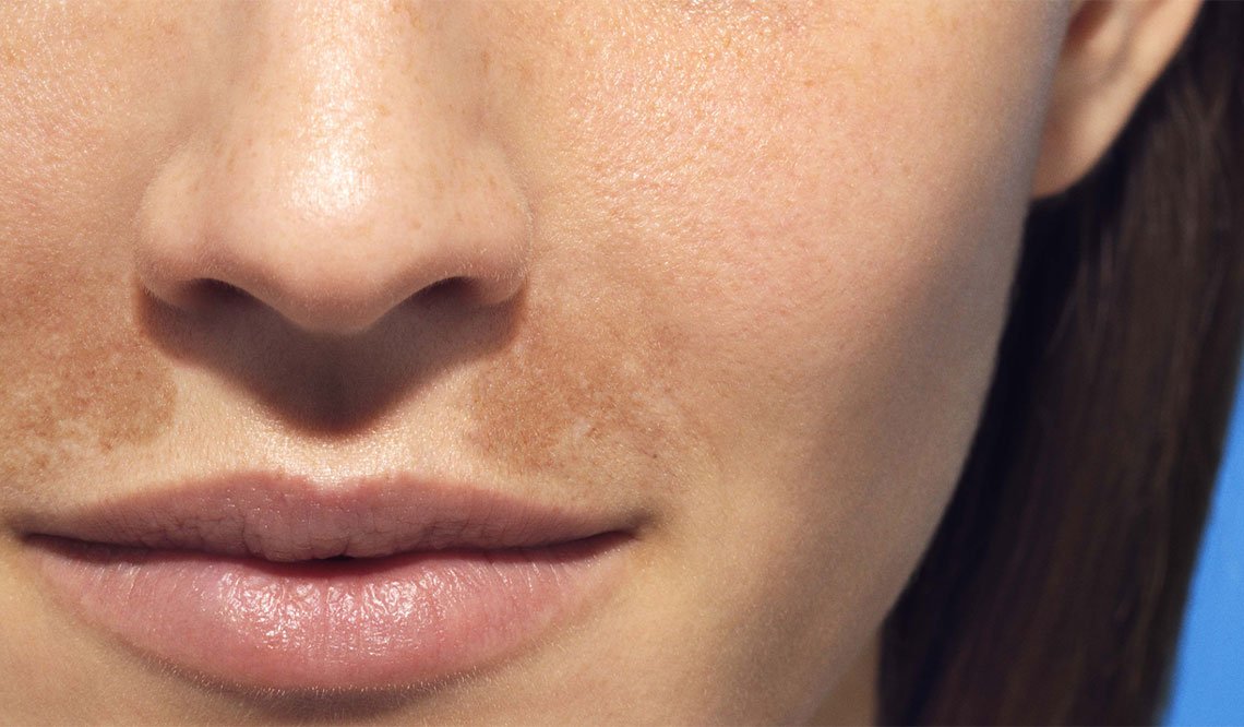 Macchie Solari Viso: Cause e Rimedi | La Roche Posay